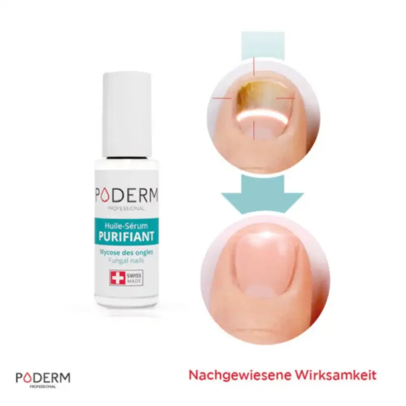 Nagelpilz Behandlung mit PODERM Serum – 8ml Purifiant